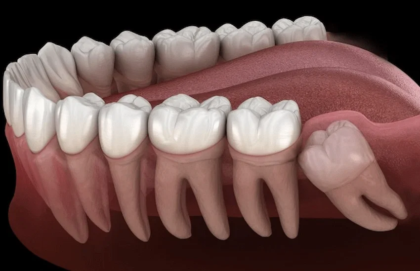 🦷¿Qué edad tienes cuando te salen las muelas de juicio | Lema Dental Clinic