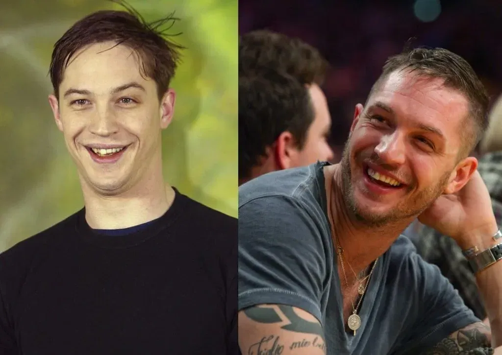 Tom Hardy New Teeth Now: Hollywood Smile Before After | LEMA