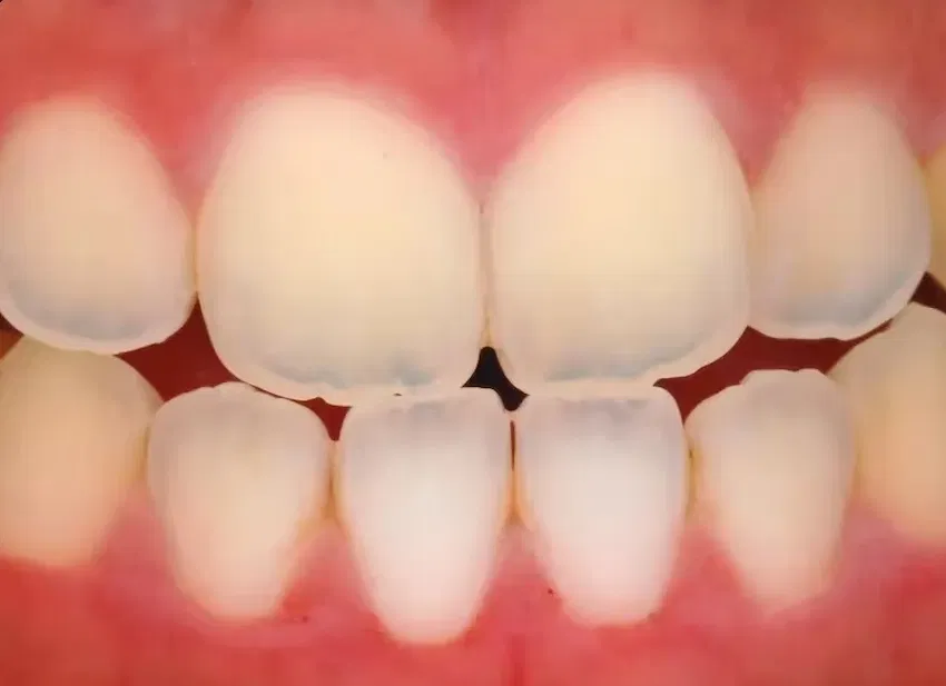 🦷What Causes Transparent Teeth? How to Fix Transparent Teeth? | LEMA