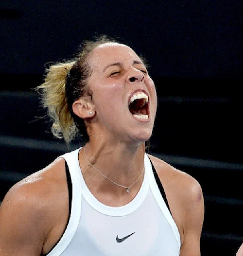 🎾 El tratamiento de ortodoncia de Madison Keys: Antes Después