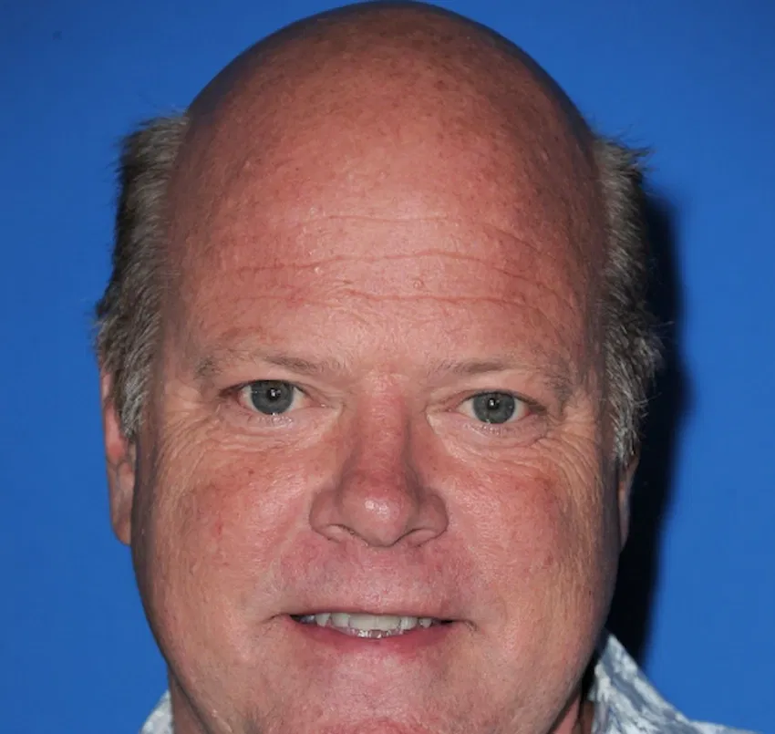 ⭐ Rex Linn Dents (Anciennes/Nouvelles) : Avant et Après | Lema Dental ...