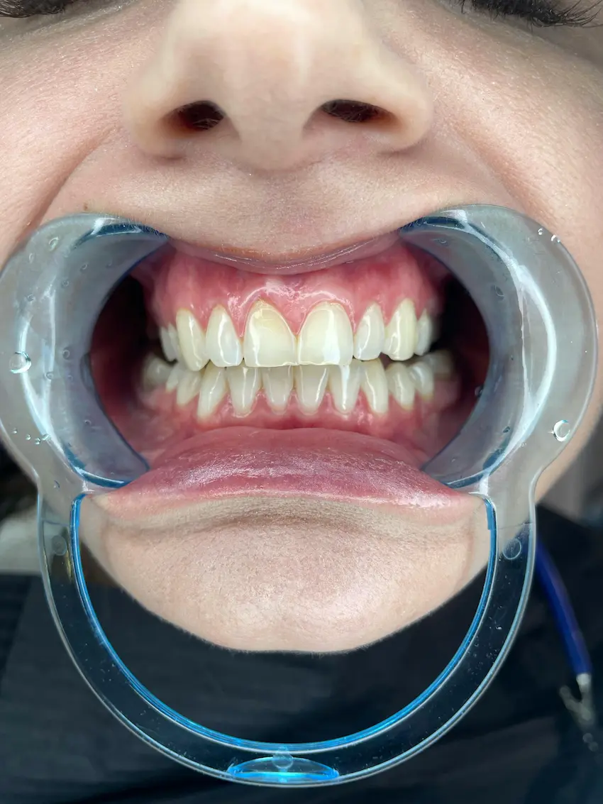 🦷Which Teeth Are Connected to the Trigeminal Nerve? | LEMA
