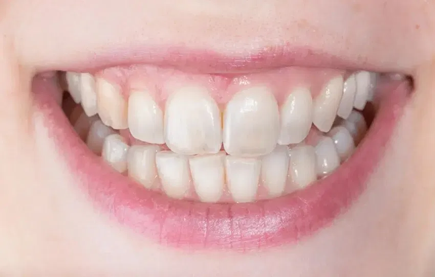 🦷What Causes Transparent Teeth? How to Fix Transparent Teeth? | LEMA