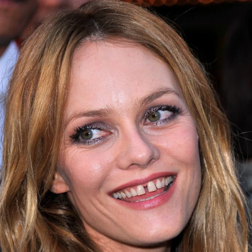 🎙️ Did Vanessa Paradis Get Her Teeth Fixed? | LEMA