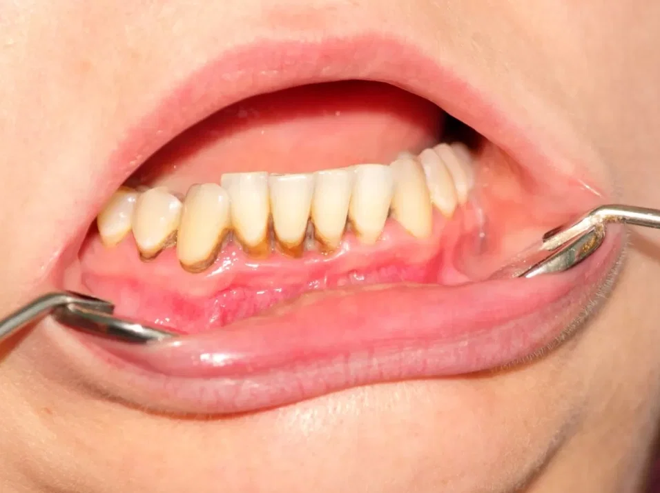 Cálculo Negro en los Dientes: Causas y Opciones de Tratamiento | Lema ...