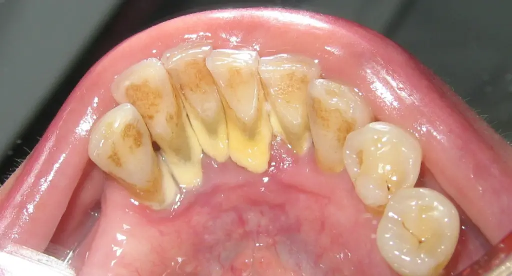 Dental Calculus Removal: Why You Can’t Do It at Home | LEMA