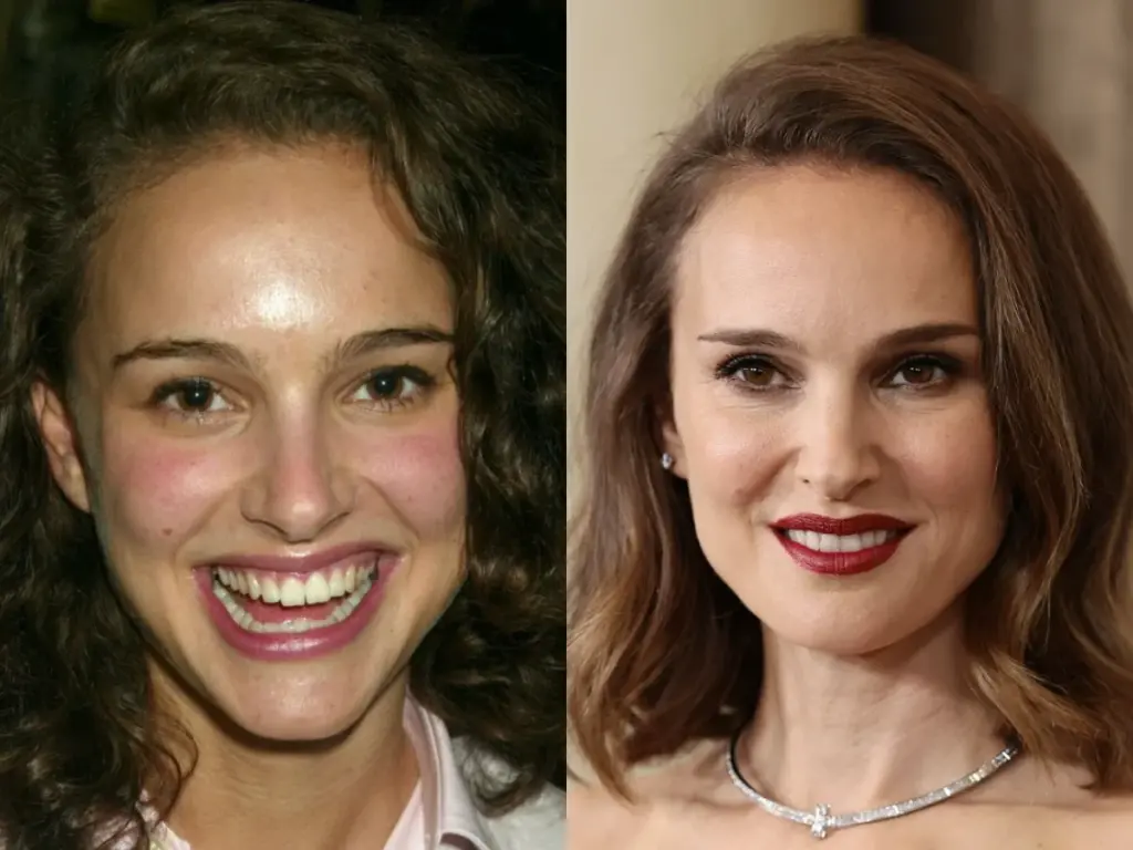 Natalie Portman’s Smile Transformation - A Journey to Perfection | LEMA