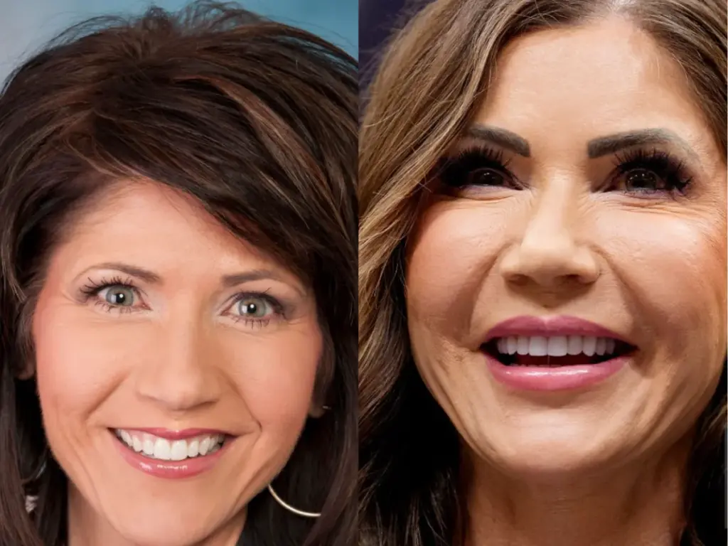 Kristi ‍ ‌‍ ‍‌ ‍ ‌‍ ‍‌ Noem New Teeth Now: Before and Afters | LEMA