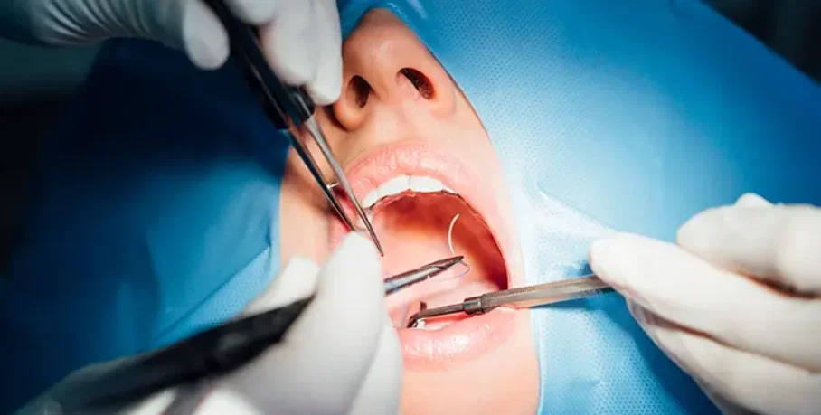Dental Code D7140: A Guide to Simple Tooth Extraction | LEMA