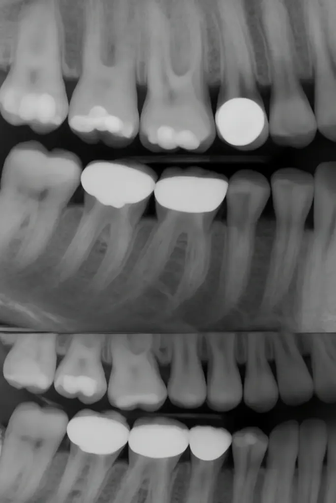 Dental Code D0274: What Does 6 Vertical Bitewing X-Rays Mean? | LEMA