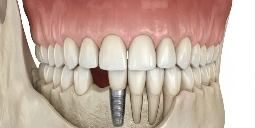 What ‍ ‌‍ ‍‌ ‍ ‌‍ ‍‌ Is the Recovery Time for All-on-4 Dental Implants ...