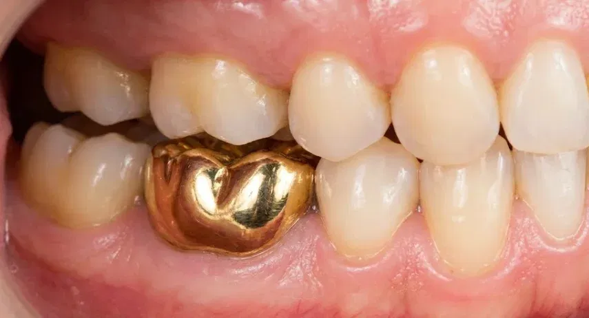 The Gold Standard: How Long Do Gold Teeth Last? | LEMA