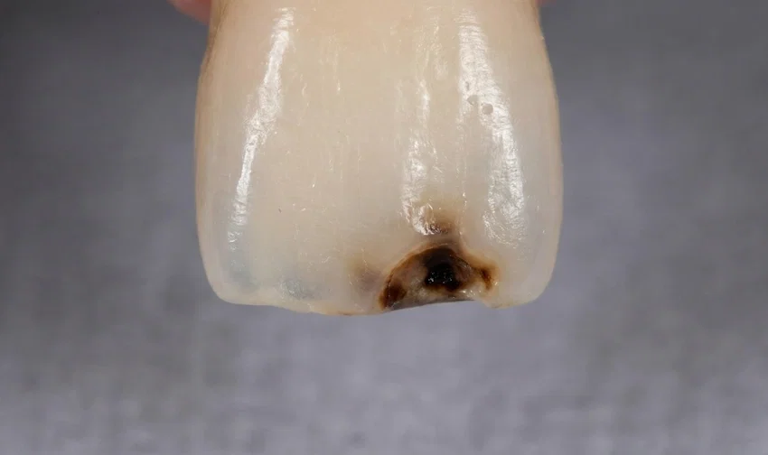 What Dental Procedure Fixes a Black Tip of a Tooth? | LEMA