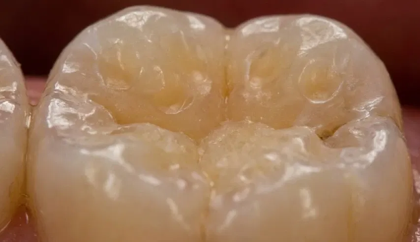 The Unseen Enemies: What Destroys Teeth the Most? | LEMA