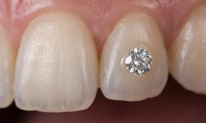 What Are the Effects of Permanent Diamond Teeth on Oral Health? | LEMA