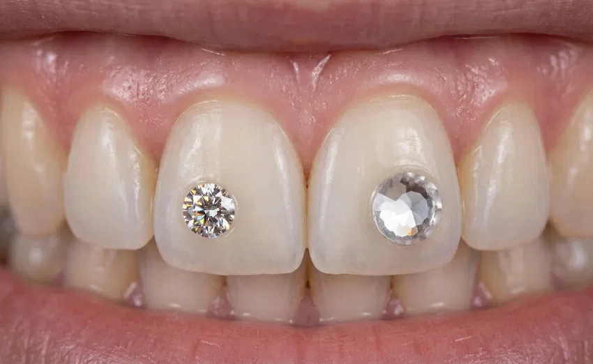 Diamond Tooth Gem vs. Crystal Tooth Gem: Which One? | LEMA