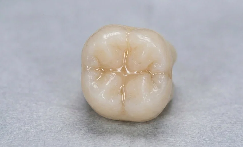 What Is A Fissure Sealant In Dentistry? | LEMA