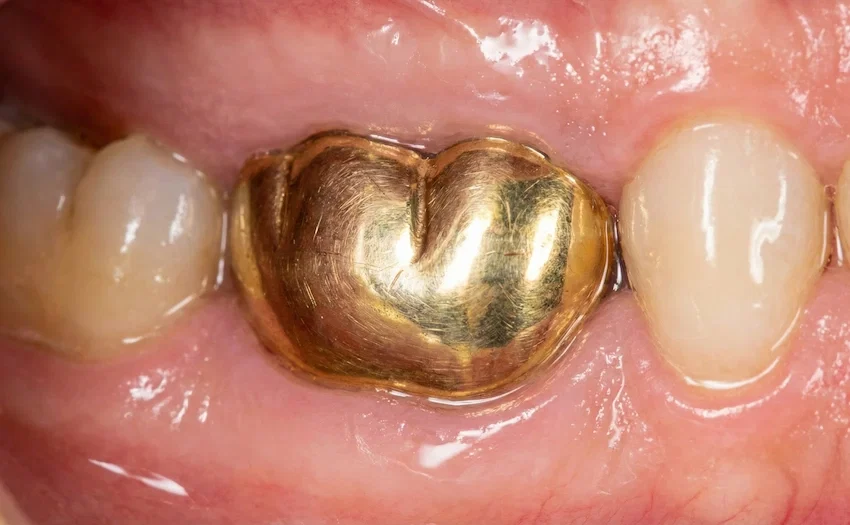 How to Handle Worn or Discolored Gold Crowns? | LEMA