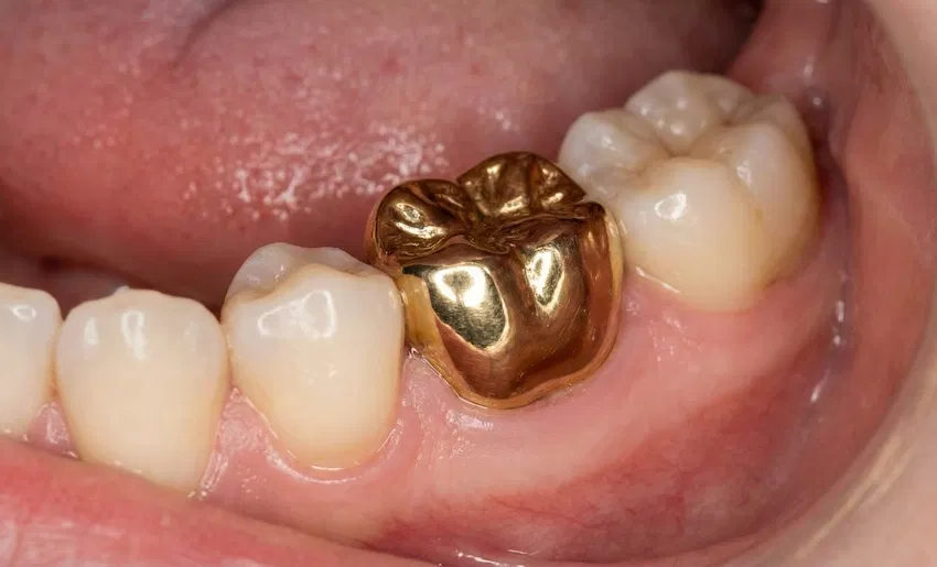 Gold Dental Crowns: Pros and Cons Explained? | LEMA