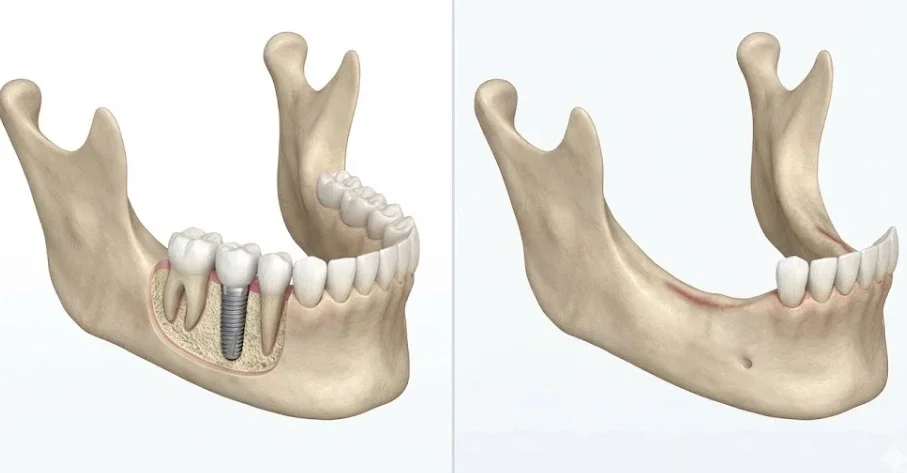 Socket Preservation: Protecting Your Future Smile | LEMA