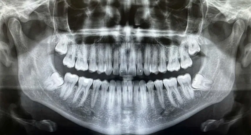 Impacted Wisdom Teeth: How Long Can You Really Delay Removal? | LEMA