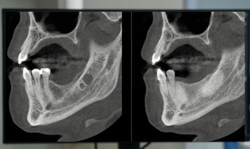 ¿Cómo tratamos la atrofia del hueso de la mandíbula | Lema Dental Clinic