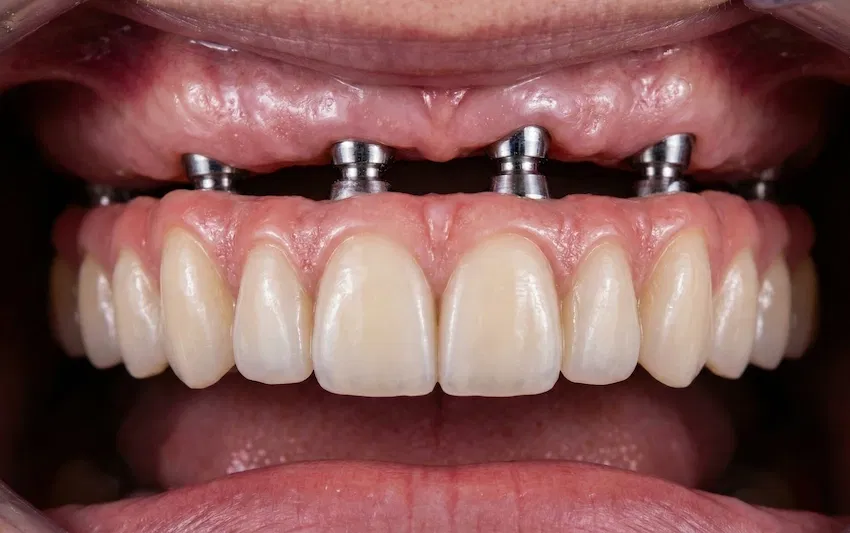 Hvad er successraten for All-on-4 tandimplantater