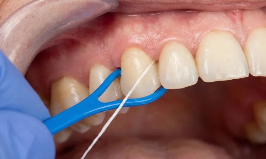 How ‍ ‌‍ ‍‌ ‍ ‌‍ ‍‌ to Floss Under a Fixed Bridge? | LEMA