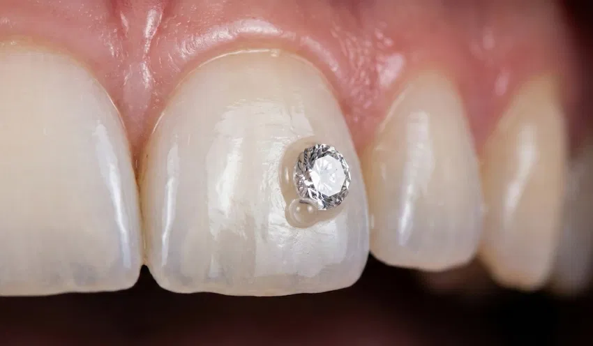 Peux-tu changer ton grillz en diamant | Lema Dental Clinic