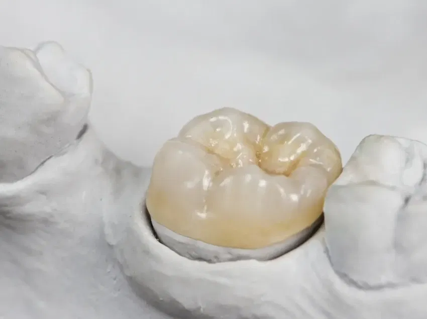 Ceramic Inlays Vs Onlays: Which One Is Right For You? | LEMA