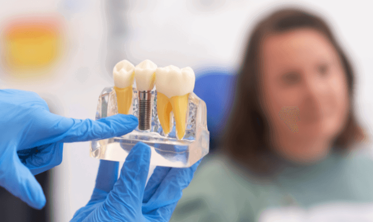 D6245 Dental Code: Ceramic Pontic on Implants Explained | LEMA